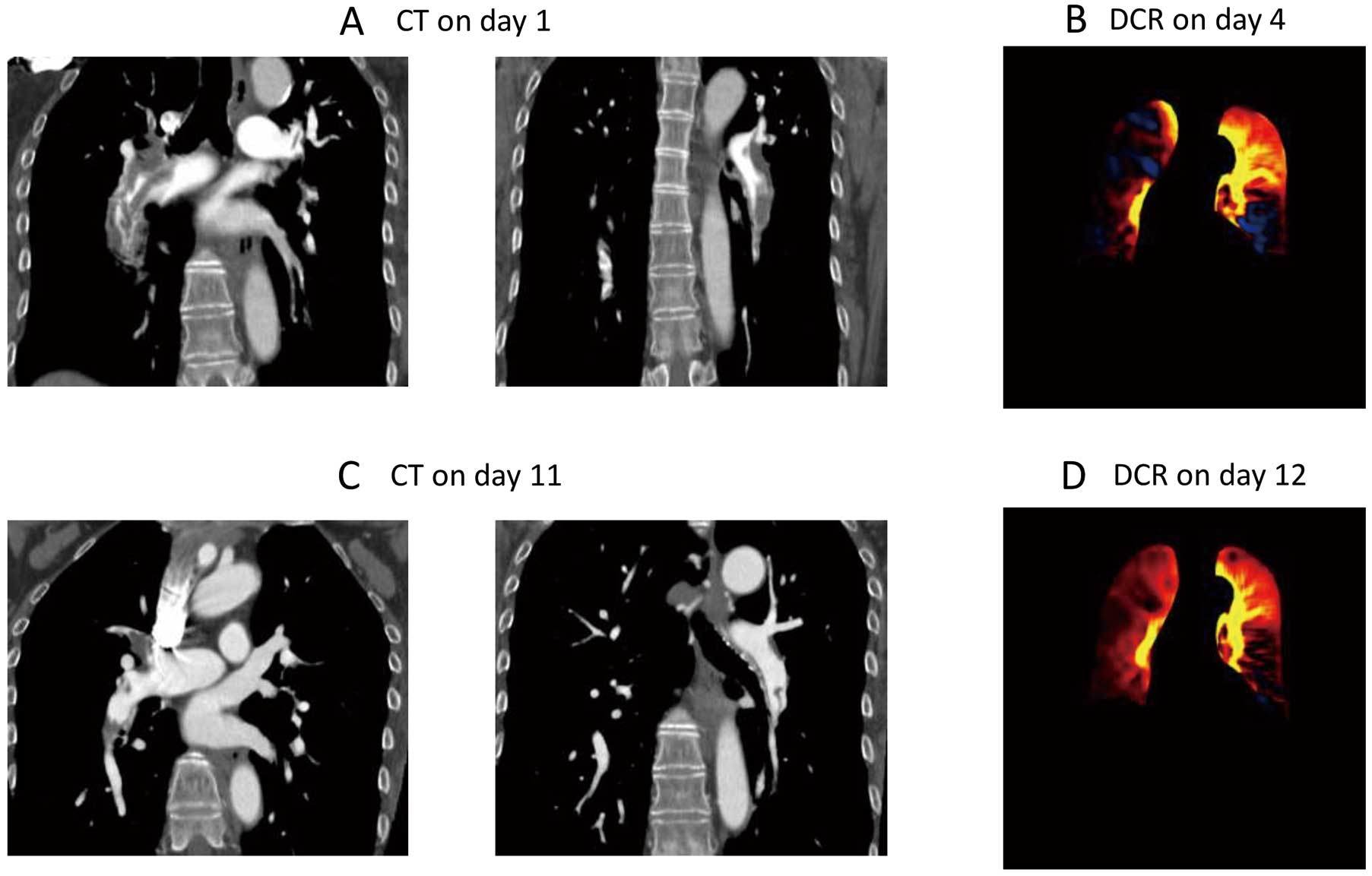 Novel Pulmonary Circulation Imaging Using Dynamic Chest Radiography for ...